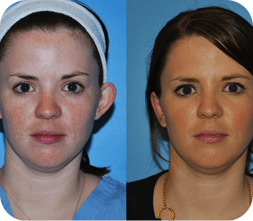 Otoplasty (Ear Reshaping Surgery) - reconplasticsurgery.in